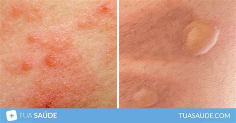 8 tipos de manchas de pele mais comuns e como tirar Tua Saúde