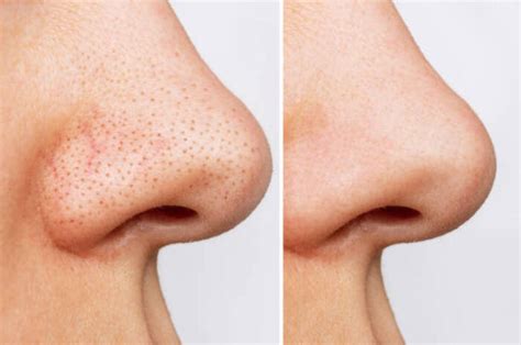 Kulit Sempurna Dengan Kombinasi Menyegarkan Nikmati Manfaat Masker