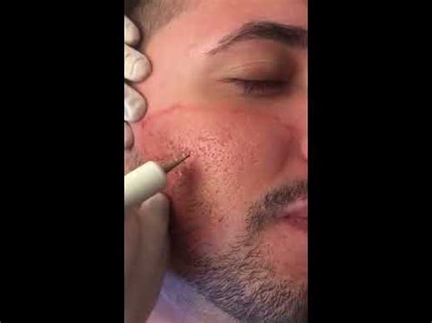 Tratamento De Cicatrizes De Acne Jato De Plasma YouTube