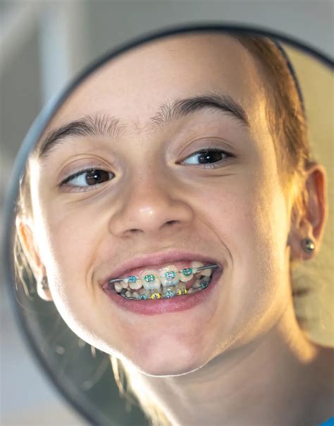 Two Phase Orthodontic Treatment Dental Specialists Turramurra