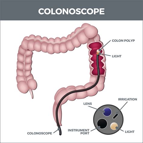 Colonoscopy Gastro Md