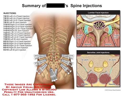 Amicus Injections Spine Spinal Cord Facet SI Joint L5 S1 L3 4 L4 5