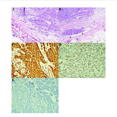 Microscopic And Immunohistochemical Findings In Peritoneal Lesions Of