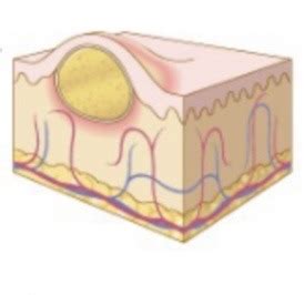 Lom Ch Skin Lesions Flashcards Quizlet