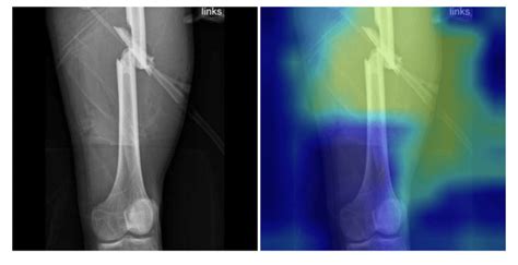 example of the fracture detection on the leg bone download scientific diagram