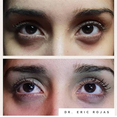 Tratamiento con láser fotona para ojeras Dr Eric Rojas
