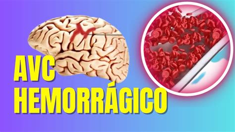 ACIDENTE VASCULAR CEREBRAL HEMORRÁGICO AVCH CAUSAS SINTOMAS E
