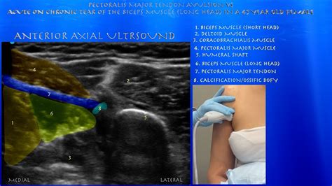 Ultrasound Of A Pectoralis Major Tendon Avulsion Vs Acute On Chronic