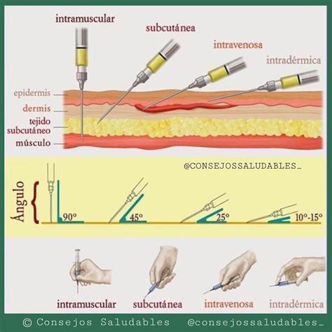 Tipos De Inyecciones Quieres Saber M S S Guenos Pideturemedio Es