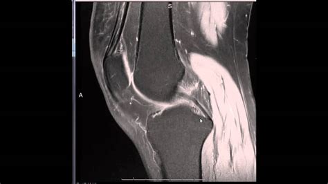 Introduction To Reading A Knee MRI YouTube