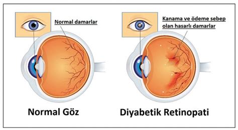 Diyabetik Retinopati Tedavisi Prof Dr Gökhan GÜLKILIK