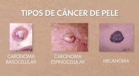 CÂNCER DE PELE Governo de Goiás disponibiliza consultas e exames para