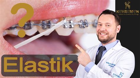 Ortodontik Lastikler Nasıl Takılır Sınıf II Elastik Kullanımı YouTube