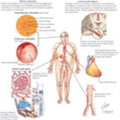 Diabetes Mellitus And Its Complications Micro And Macrovascular