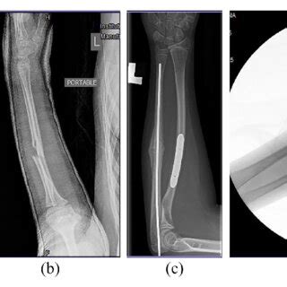 AP A And Lateral B Radiographs Following Initial Closed Reduction