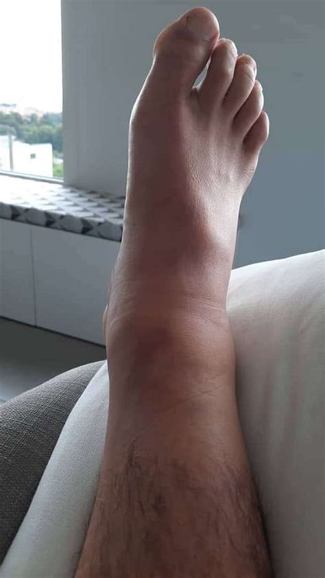 Acute Injury Terramed Physio Rehab