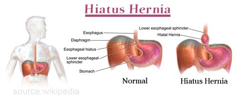 Hiatus Hernia Types Causes Symptoms Complications Diagnosis