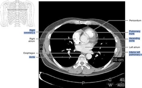 Ct Of The Thorax Radiology Key