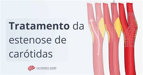 Angioplastia da carótida stent Tratamento da doença carotídea