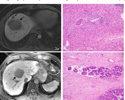 Figure 2 From MRI Features For Predicting Microvascular Invasion And