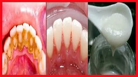 COMO TIRAR TARTARO DOS DENTES E CLAREAR OS DENTES EM 3 MINUTOS HOW TO