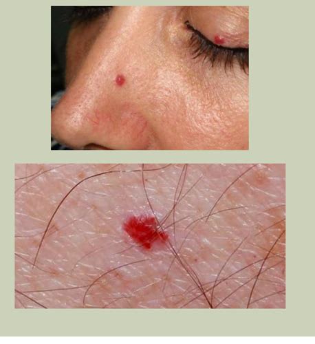 Benign Skin Lesions Flashcards Quizlet