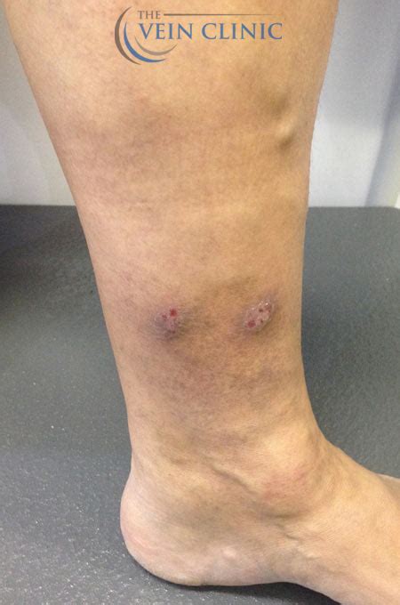 Venous Ulcers Symptoms Treatment Vein Clinic Perth