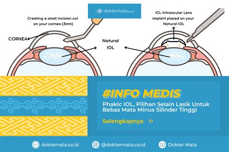 Phakic IOL Pilihan Selain Lasik Untuk Bebas Mata Minus Silinder Tinggi
