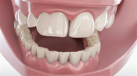 Discover The Cost Of Dental Bridges In Europe What Is The Average