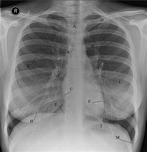 Lateral Chest Radiograph Anatomy