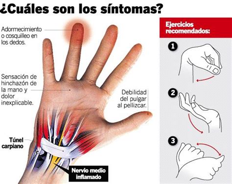 Trastorno de la muñeca abierta o esguince de muñeca Blog de farmacia