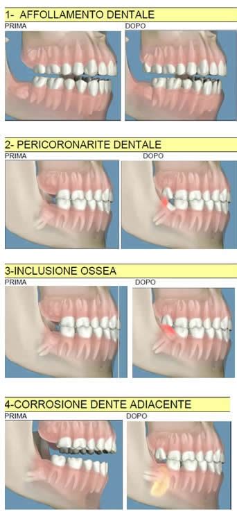 Alveolite Dentale Cos Cause Sintomi E Cura
