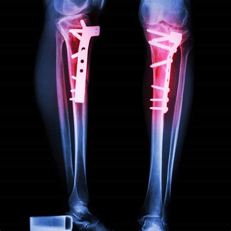 Tibia Fractures Types Symptoms Treatments Heiden Orthopedics