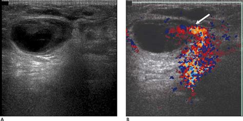Sonography Of Various Cystic Masses Of The Female Groin Oh 2007 Journal Of Ultrasound In