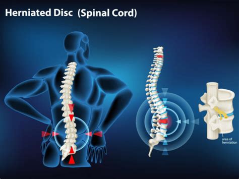 The Latest Advancements In Minimally Invasive Spine Surgery