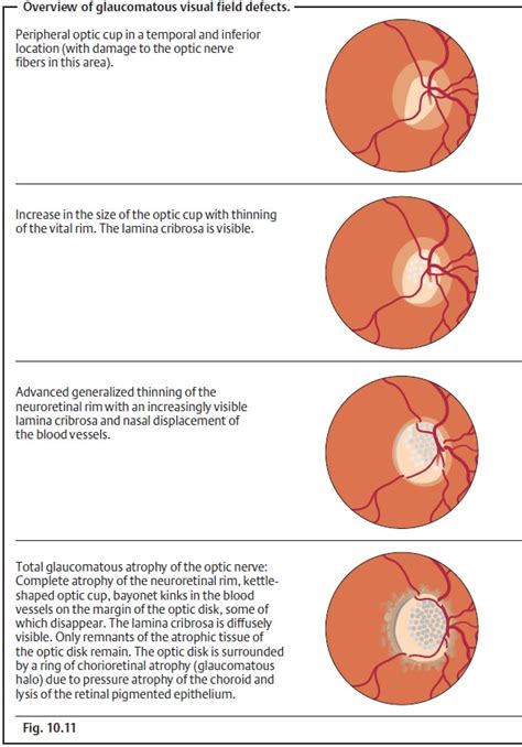 Glaucoma Examination Methods