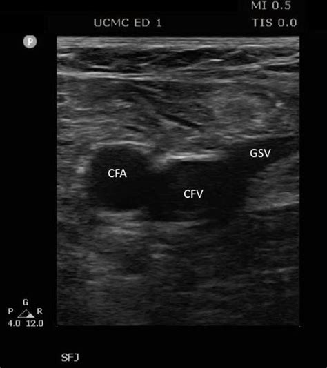 Deep Femoral Artery Ultrasound