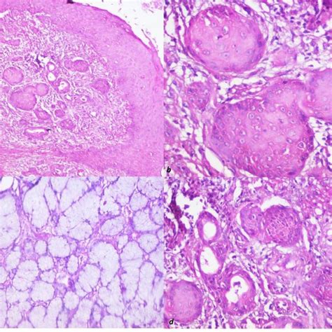 The Photomicrographs Of H E Stained Section Of Case 1 Under 10X Shows