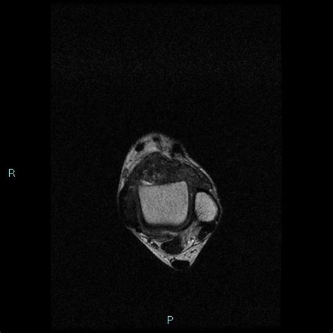 Pigmented Villonodular Synovitis Ankle Image Radiopaedia Org