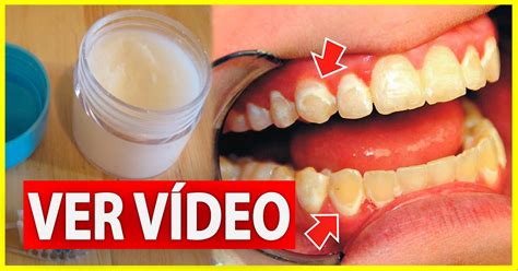 Cómo eliminar el sarro en los dientes naturalmente sin tener que ir al