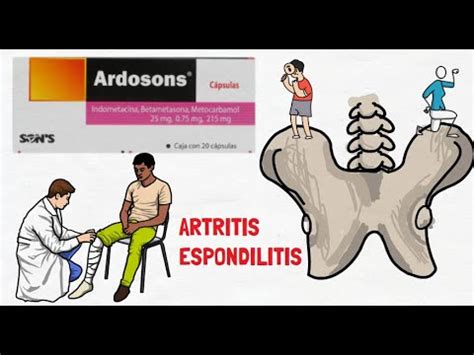 ARDOSONS PARA QUÉ SIRVE YouTube
