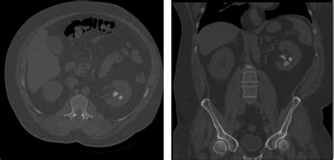 Madrid Urolog A Litiasis Urinaria Pruebas De Imagen