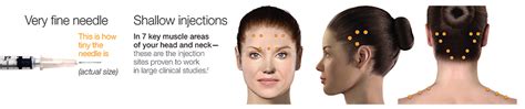 Botox Injection Site Muscle Groups