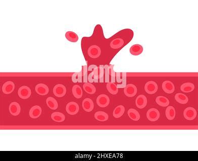 Vein Artery Rupture Cut Blood Hemorrhage Internal Bleeding Cut Of A