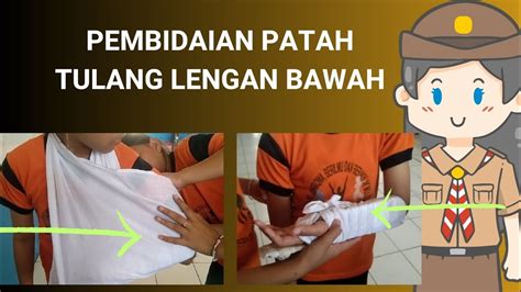 PEMBIDAIAN PATAH TULANG LENGAN BAWAH PRAMUKA P3K YouTube