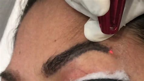 Despigmentação remoção de micropigmentação a laser YouTube