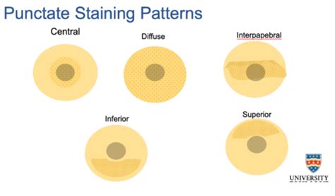 Contact Lens Complications Corneal Staining Flashcards Quizlet