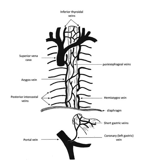Superior Vena Cava Syndrome Collateral Circulation