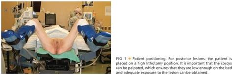 Female Colonoscopy Lithotomy Position