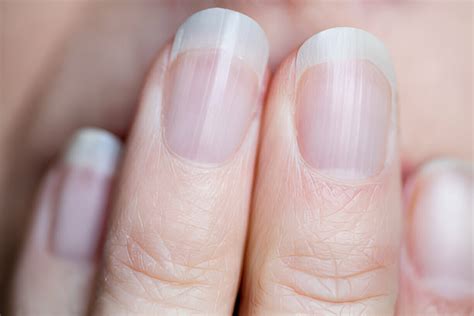 Tout Savoir sur les Ongles Striés Causes et Solutions
